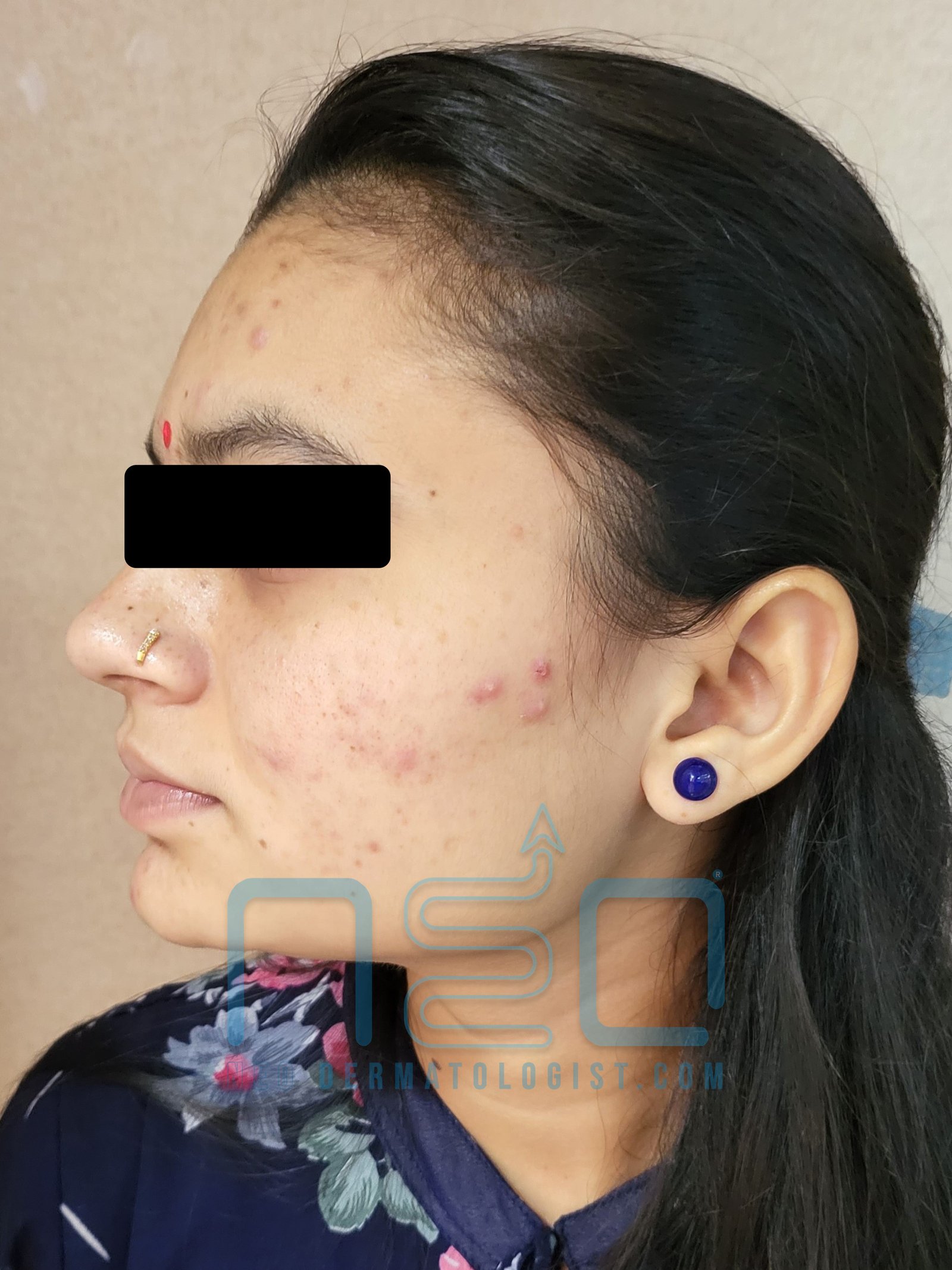 Acne Treatment Online, Acne Doctor Online Consultation