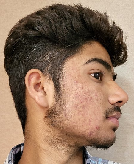 Acne Treatment Online, Acne Doctor Online Consultation